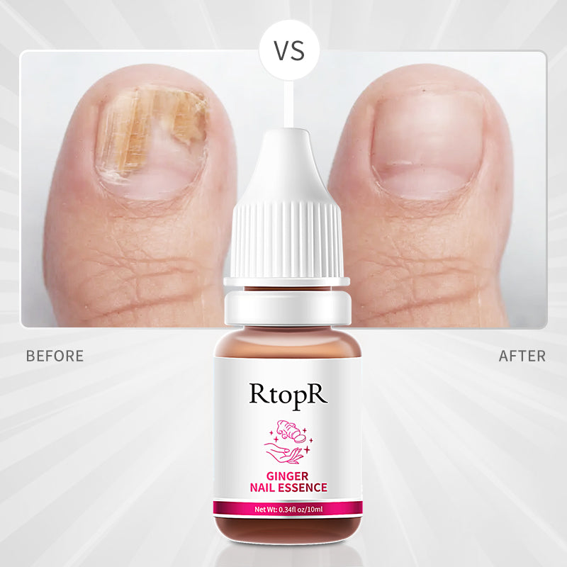 RtopR【Official Store】Ginger Nail Essence Nail Repair Serum for Cracked ...